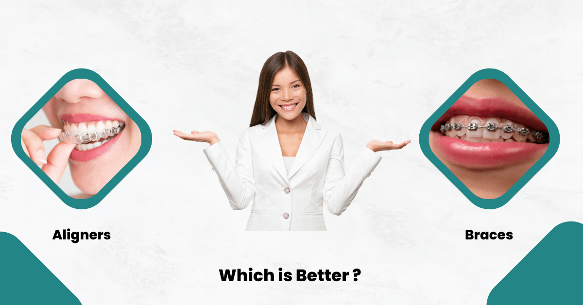 Aligners vs. Braces – Which is Better? - Bombay Dental Specialities