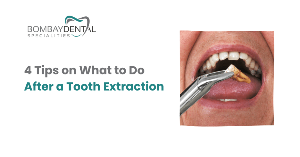 4 Tips on What to Do After A Tooth Extraction | Tips for After a Tooth ...